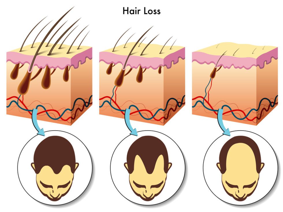 Male Pattern Baldness: Causes | Concord Hair Restoration
